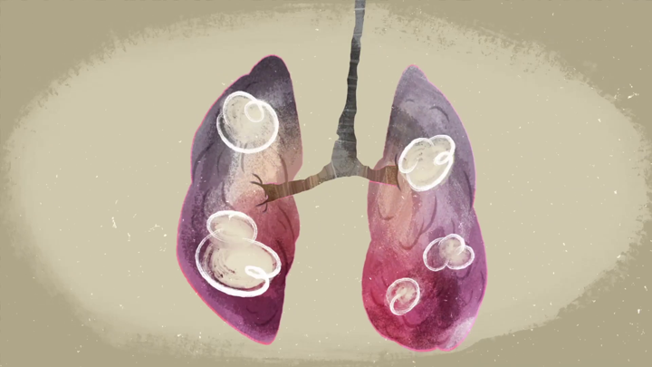 Part 1: Cotton Candy Sewer Juice: How Vaping Hurts Your Lungs | Video ...